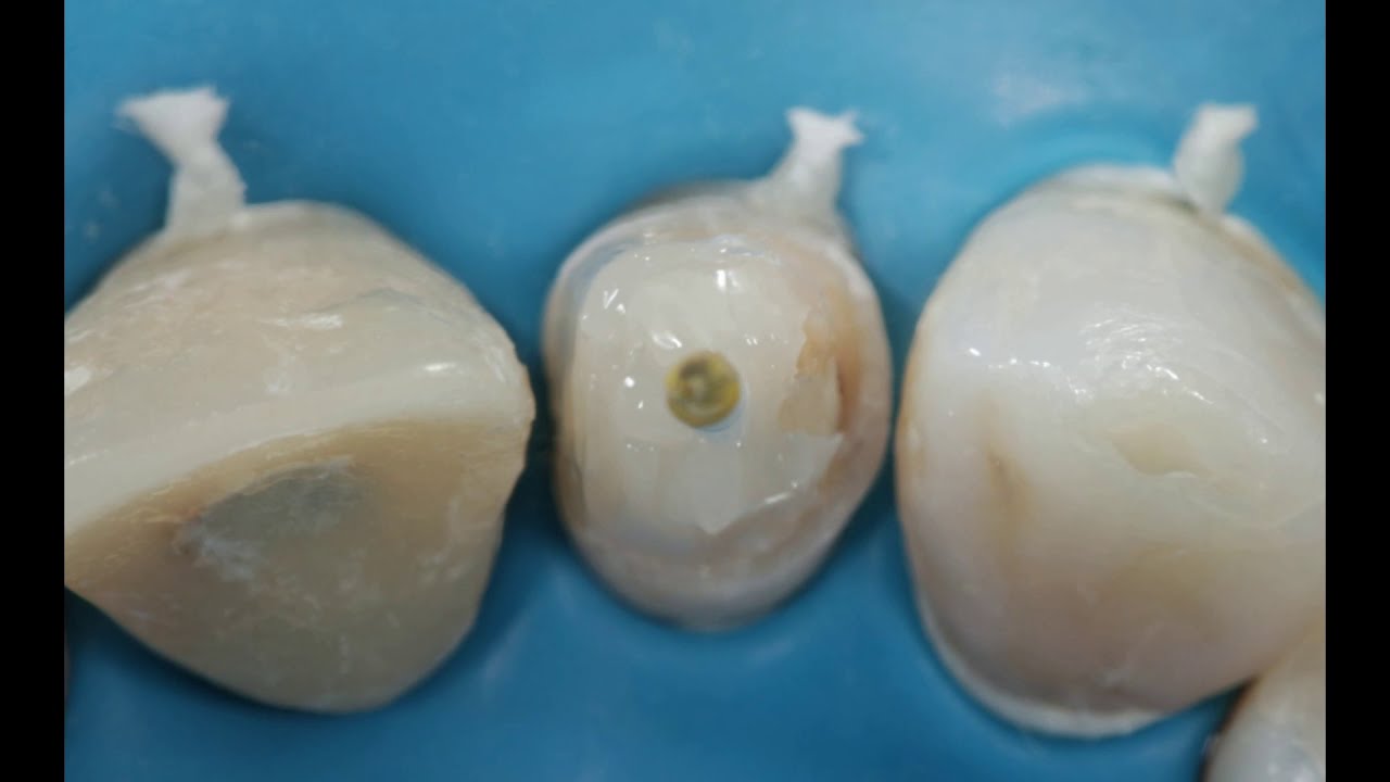 FIBER REINFORCED POST SYSTEM - YouTube