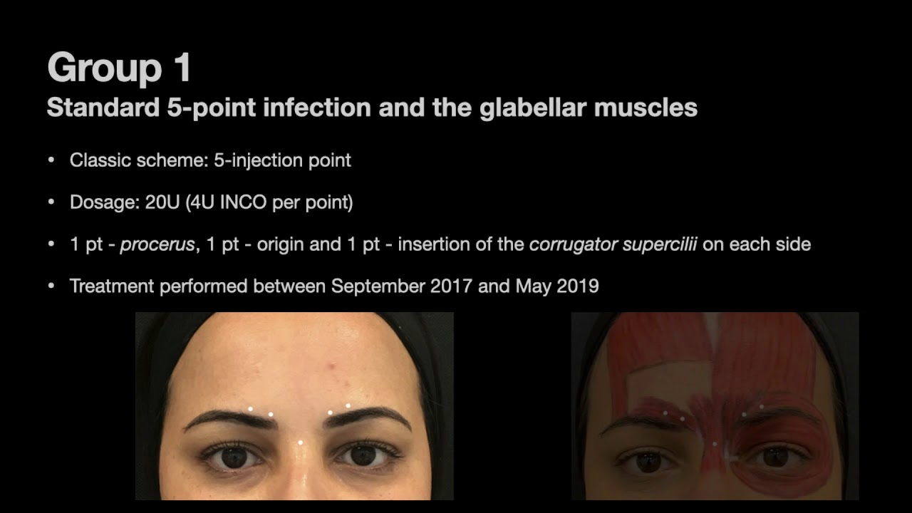 The One21 technique: An individualized treatment for glabellar lines ...