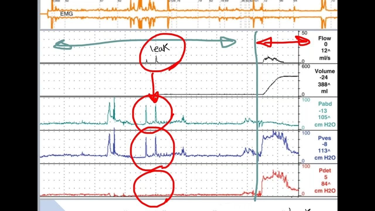 how to interpret cystometry (urodynamics) - YouTube