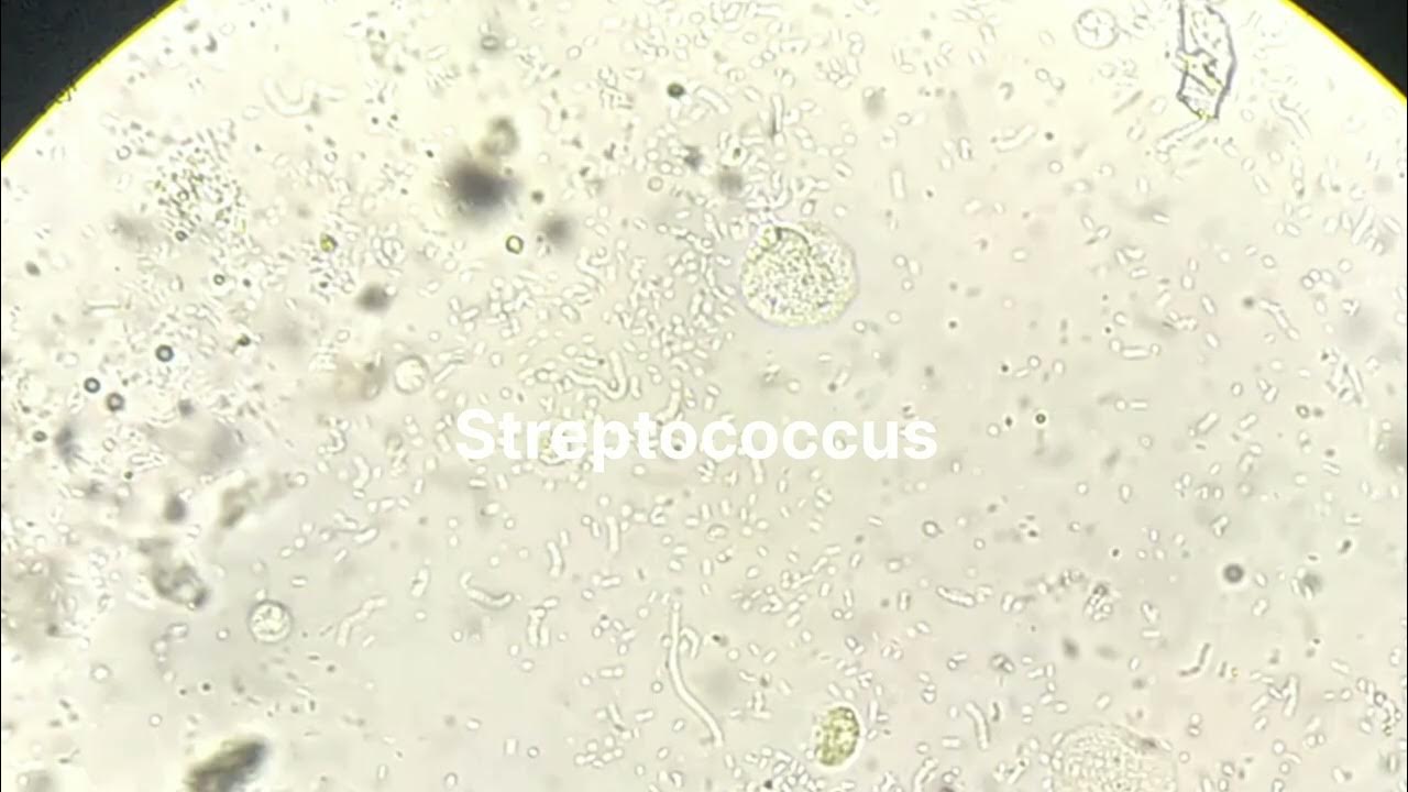 Full Field Bacteria Under Microscope In Urine Examinationhighly Motile Spermatozoa And Pus Cell