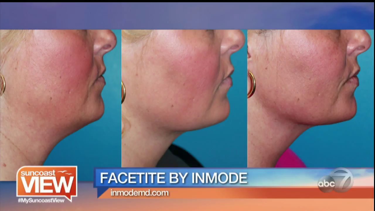 FaceTITE by InMode on ABC Suncoast View - YouTube