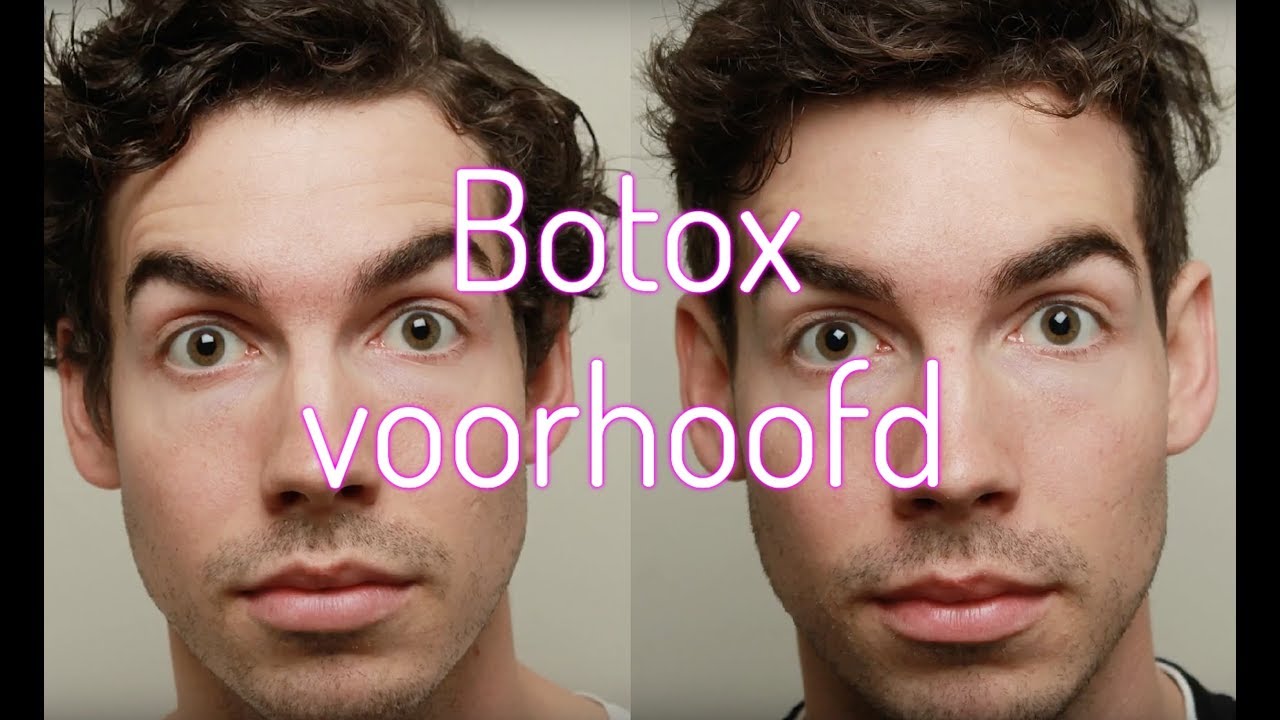 Botox voorhoofd | Furrow.nl - YouTube