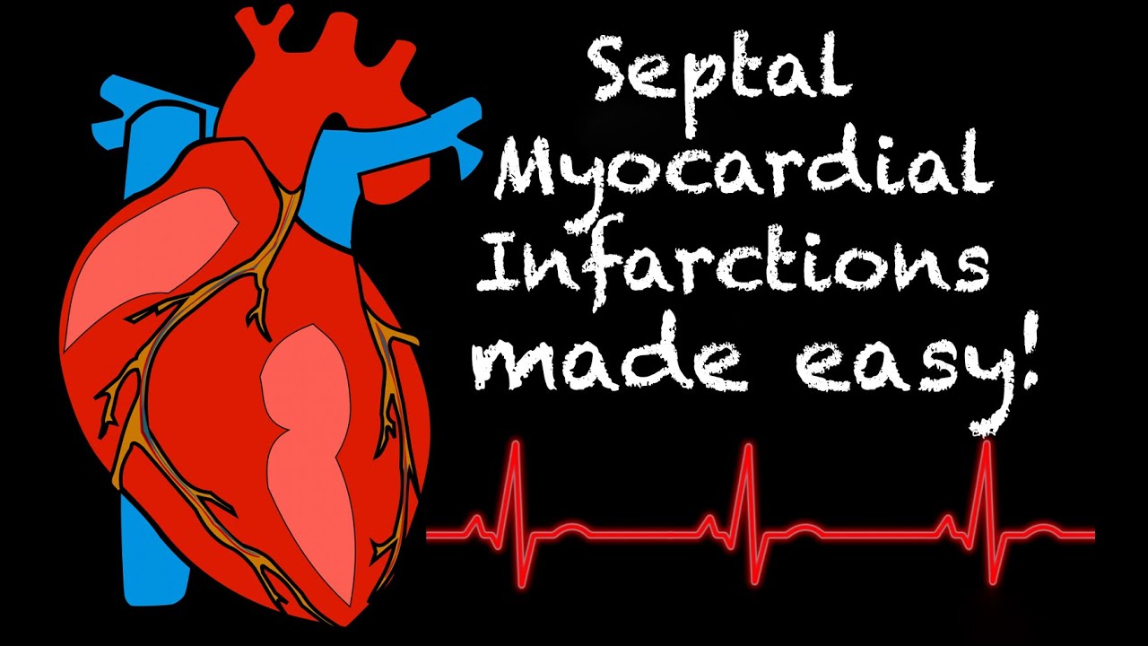 Infarction Ekg Septal Infarct ST Segment Elevation Myocardial