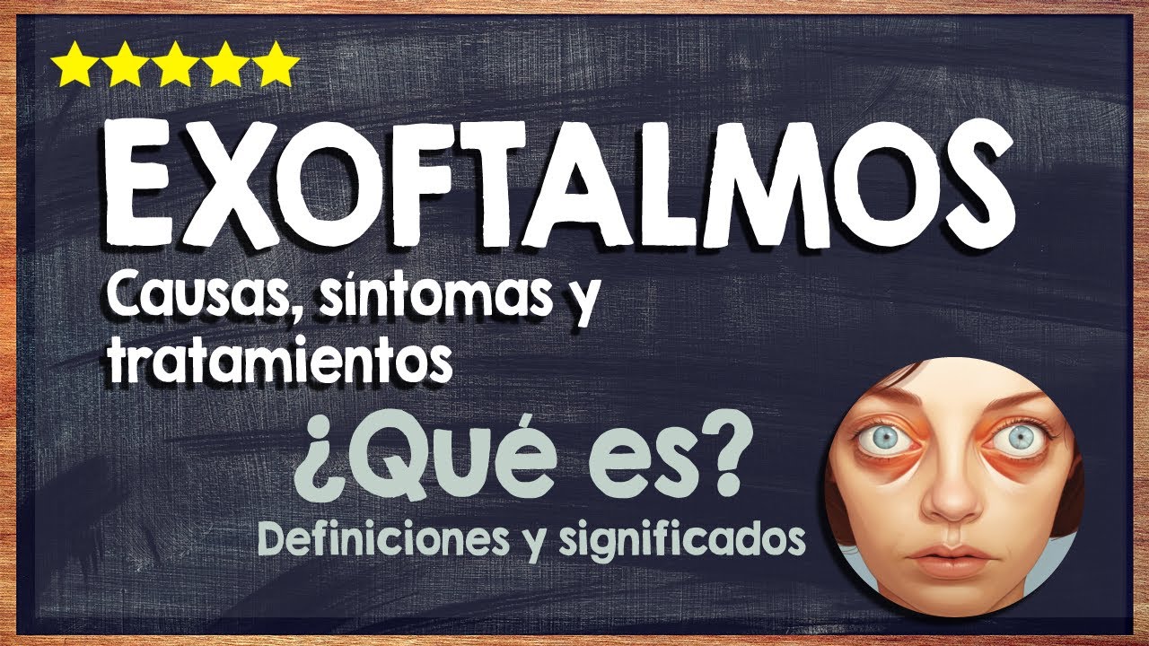 🙏 ¿Qué es Exoftalmos? - Causas, Síntomas y Tratamientos 🙏 - YouTube