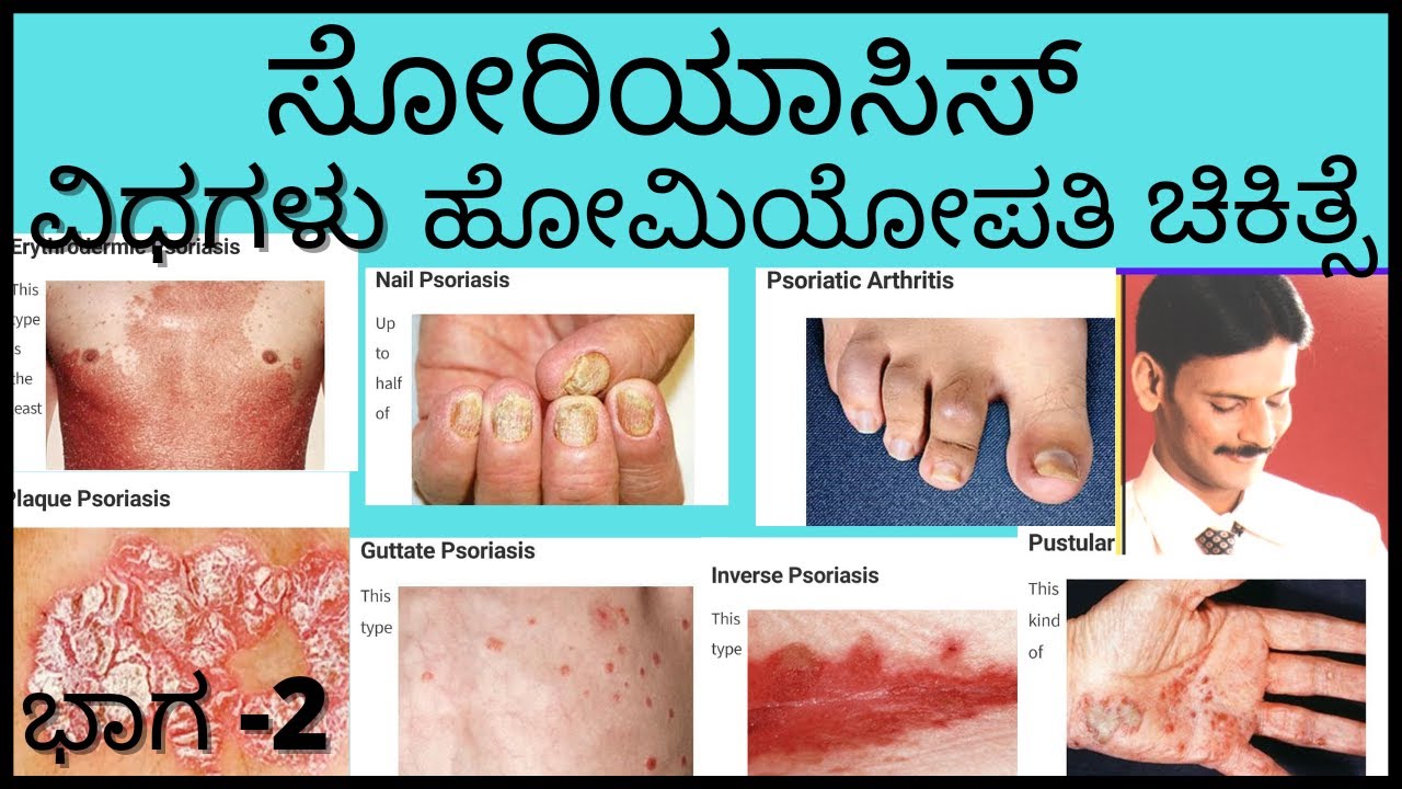 Psoriasis Symptoms Cause And Treatment In Kannada What Is Psoriasis psoriasis-symptoms-cause-and-treatment-in-kannada-what-is-psoriasis