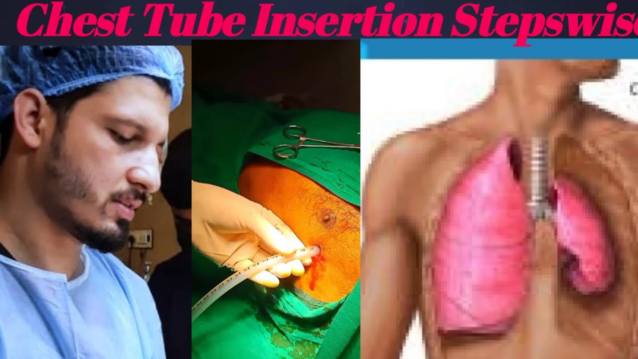 chest tube placement Stepwise/NLE/PMDC\FCPS MS IMM/triangle of safety ...