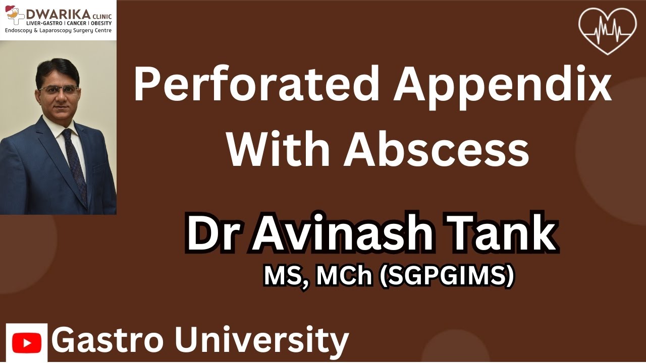 Surgery for Appendicular Abscess with Cavity. Dr Avinash Tank. Dwarika ...