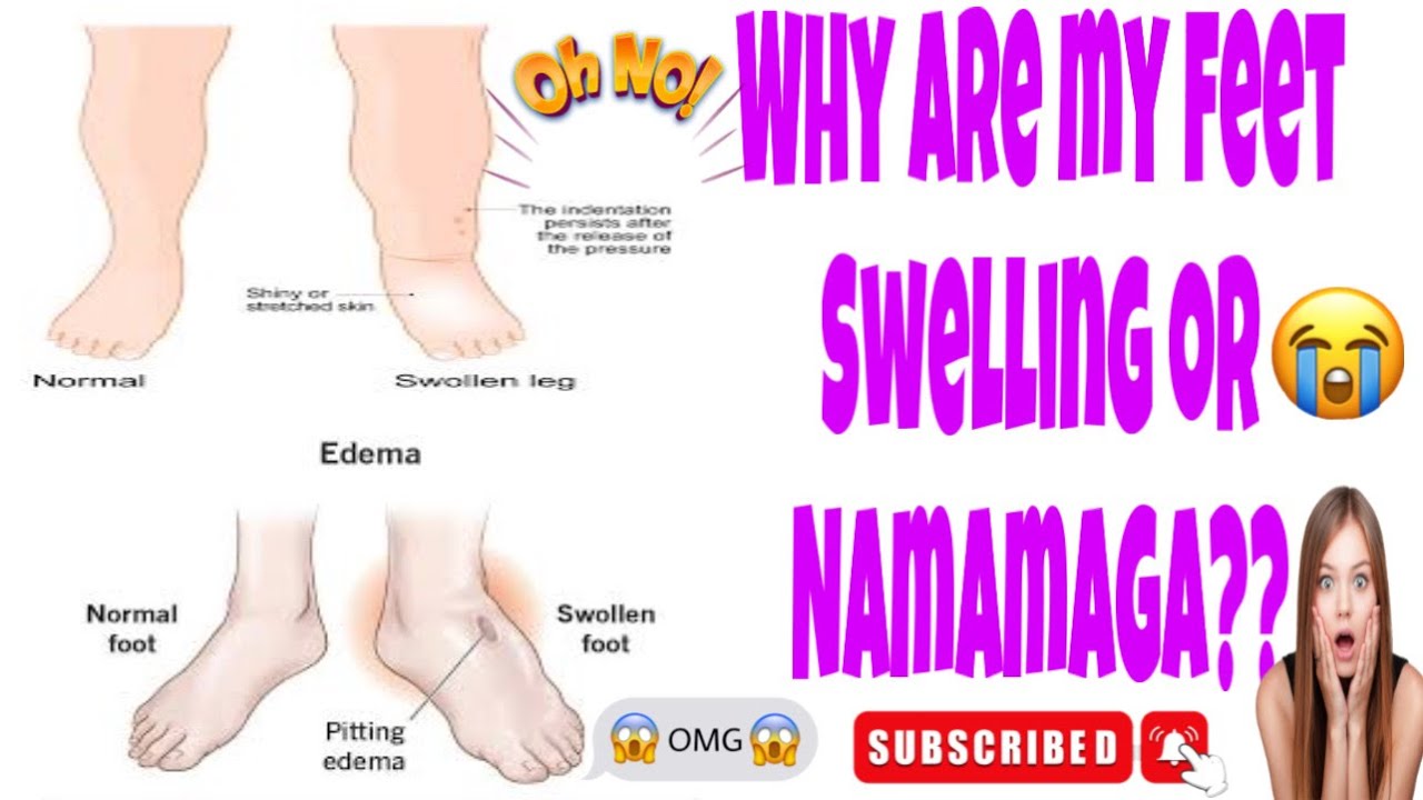 Oh No!Why Are My Feet Swelling??Or Nagmamanas At Namamaga??@aliansa273 - YouTube
