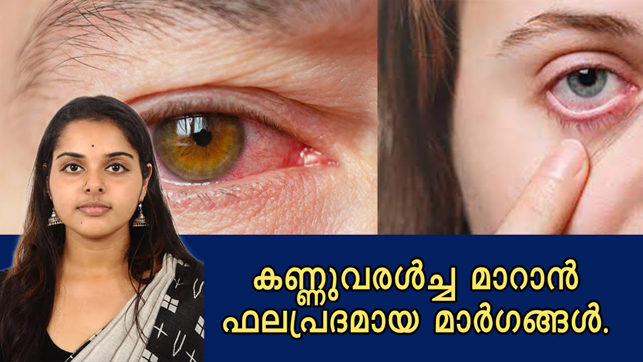 159 | കണ്ണുവരൾച്ച മാറാൻ ഫലപ്രദമായ മാർഗങ്ങൾ | What is Dry Eyes - YouTube