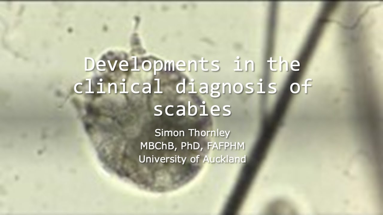 Dr Simon Thornely - Developments in the clinical diagnosis of scabies ...