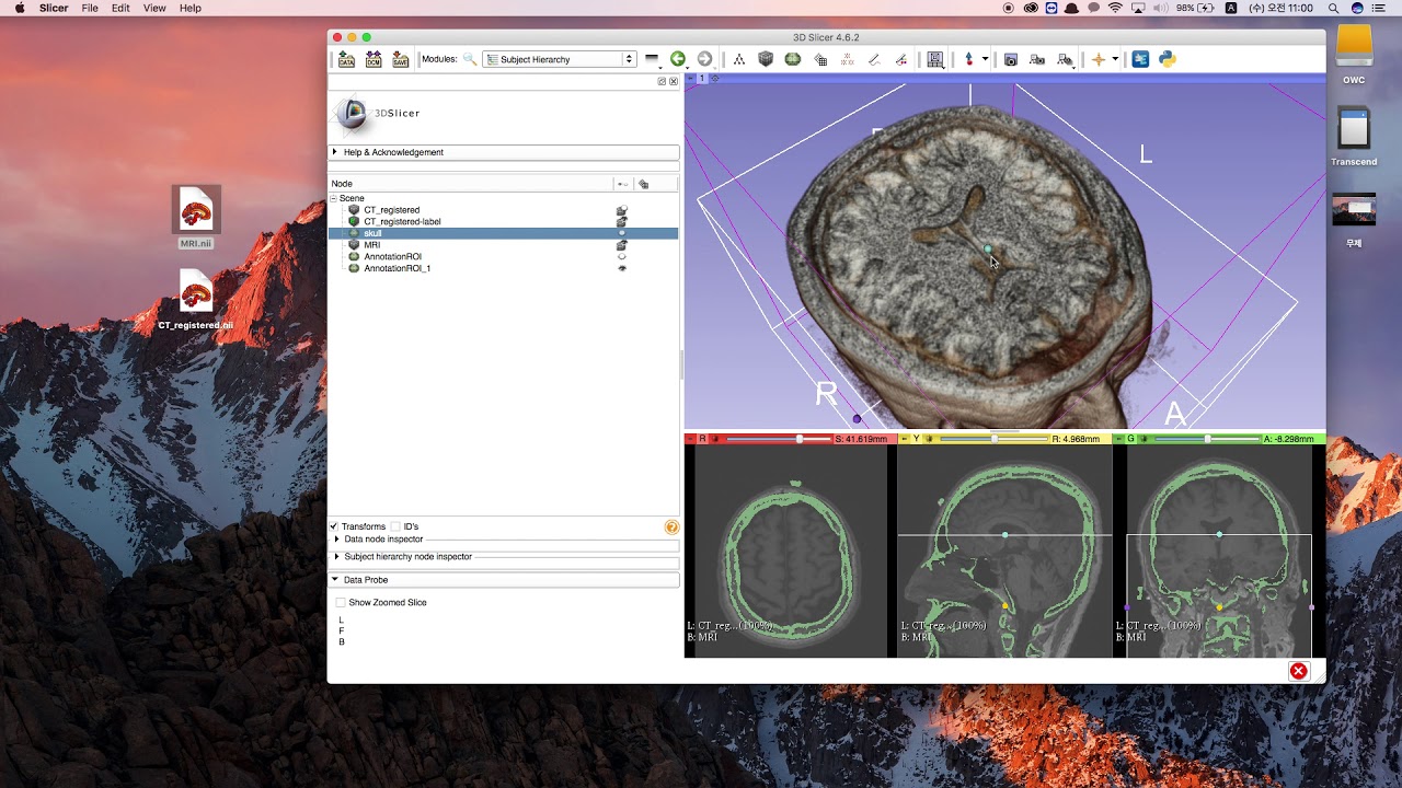 Brain volume rendering (using 3D slicer) - YouTube
