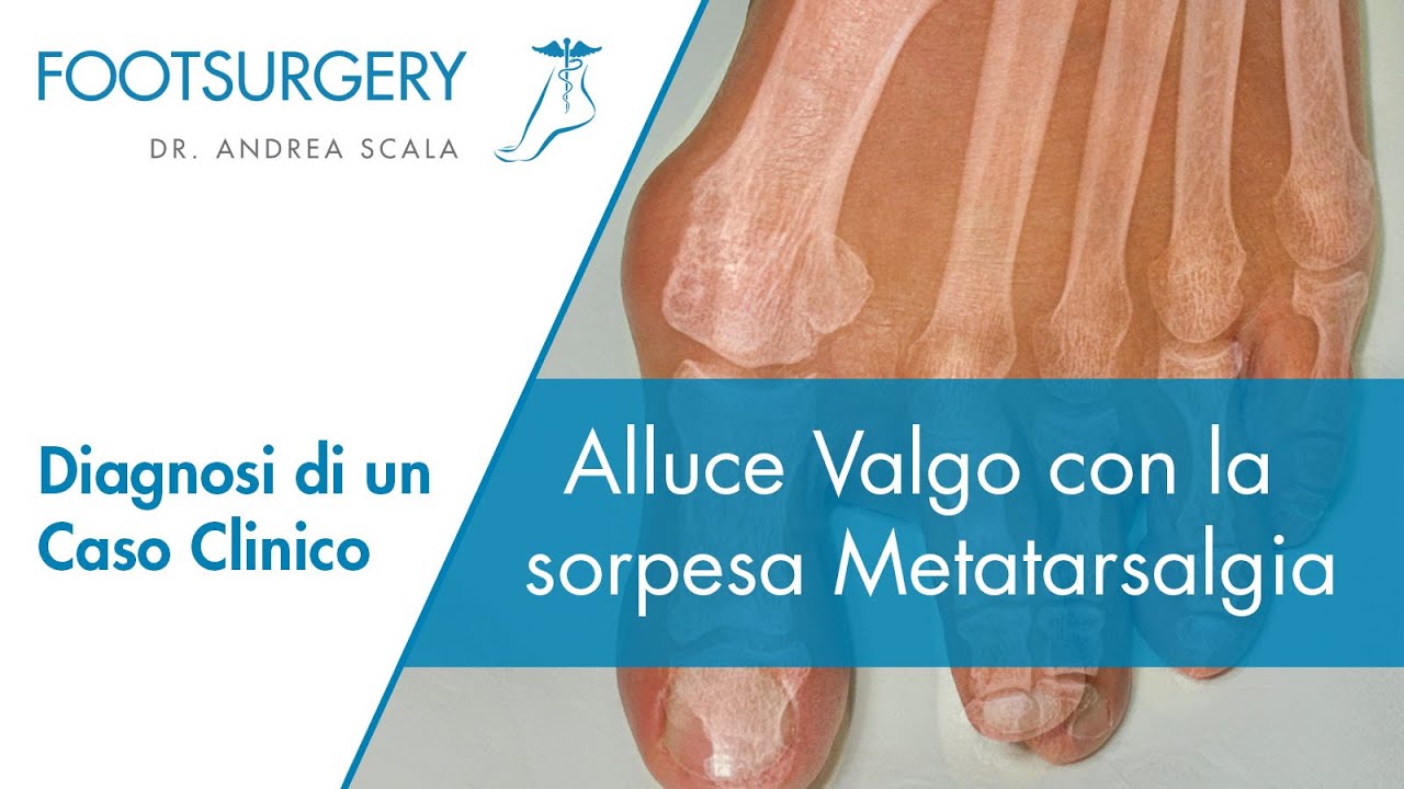 Alluce Valgo diagnosi con sorpresa, la metatarsalgia | Metatarsalgia e ...
