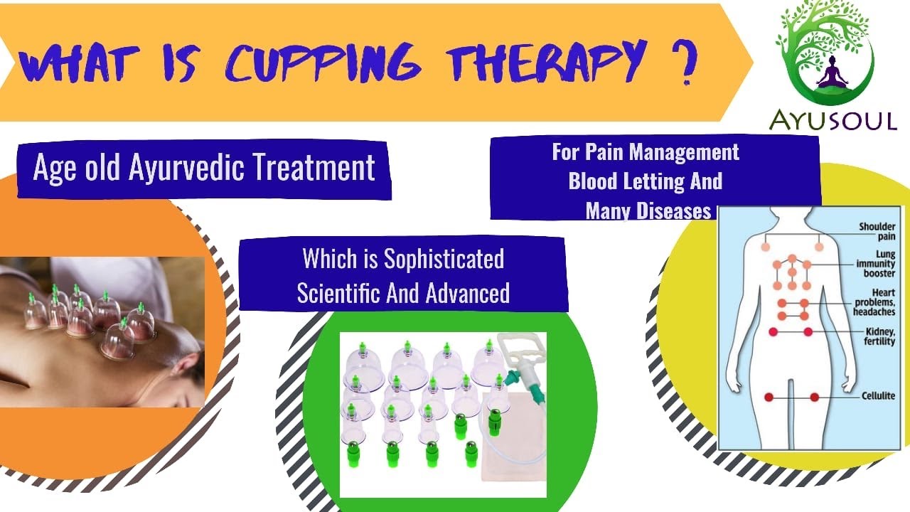 What is cupping therapy? How it is performed? - YouTube