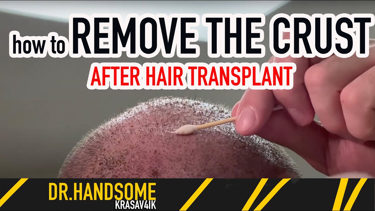 How to remove the crust after hair transplant surgery \ Dr Handsome ...