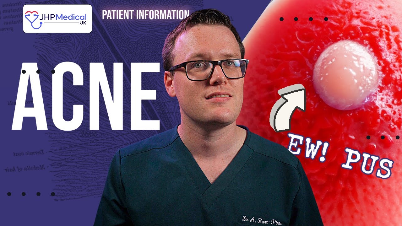 ACNE | Doctor explains How to GET RID of Spots, Blackheads, Whiteheads ...