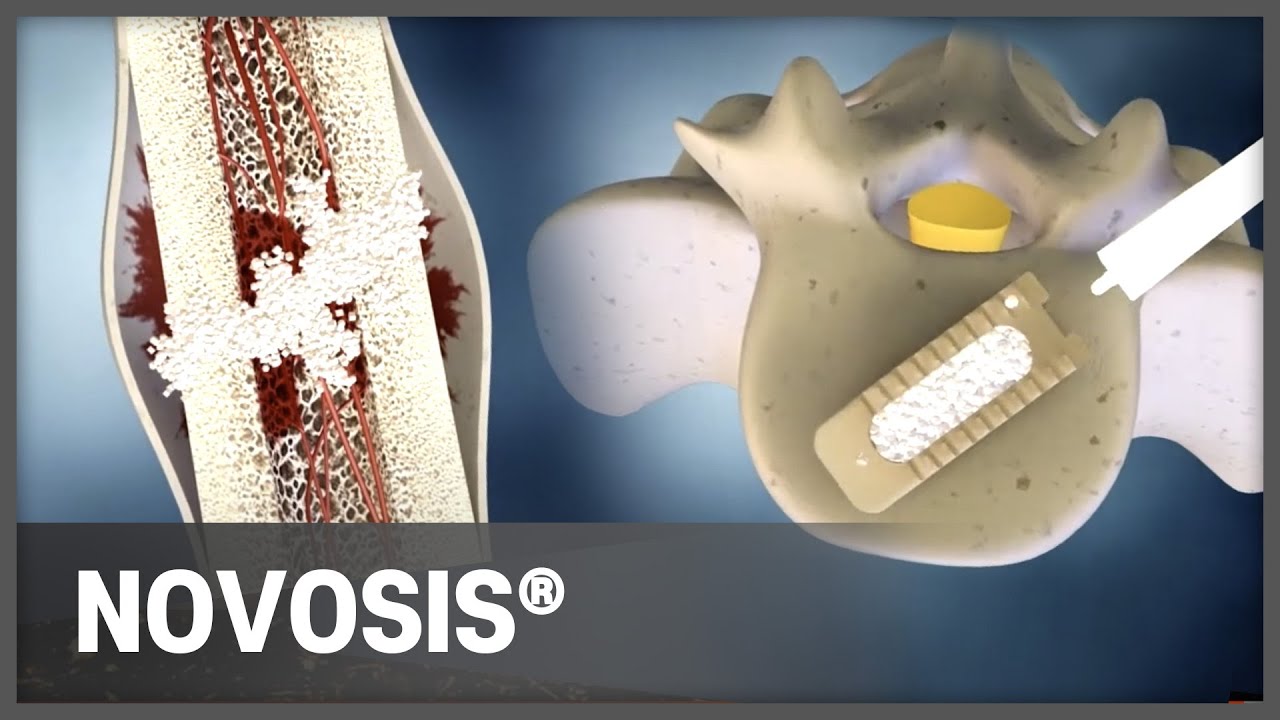 [BONE/SPINAL] NOVOSIS - YouTube