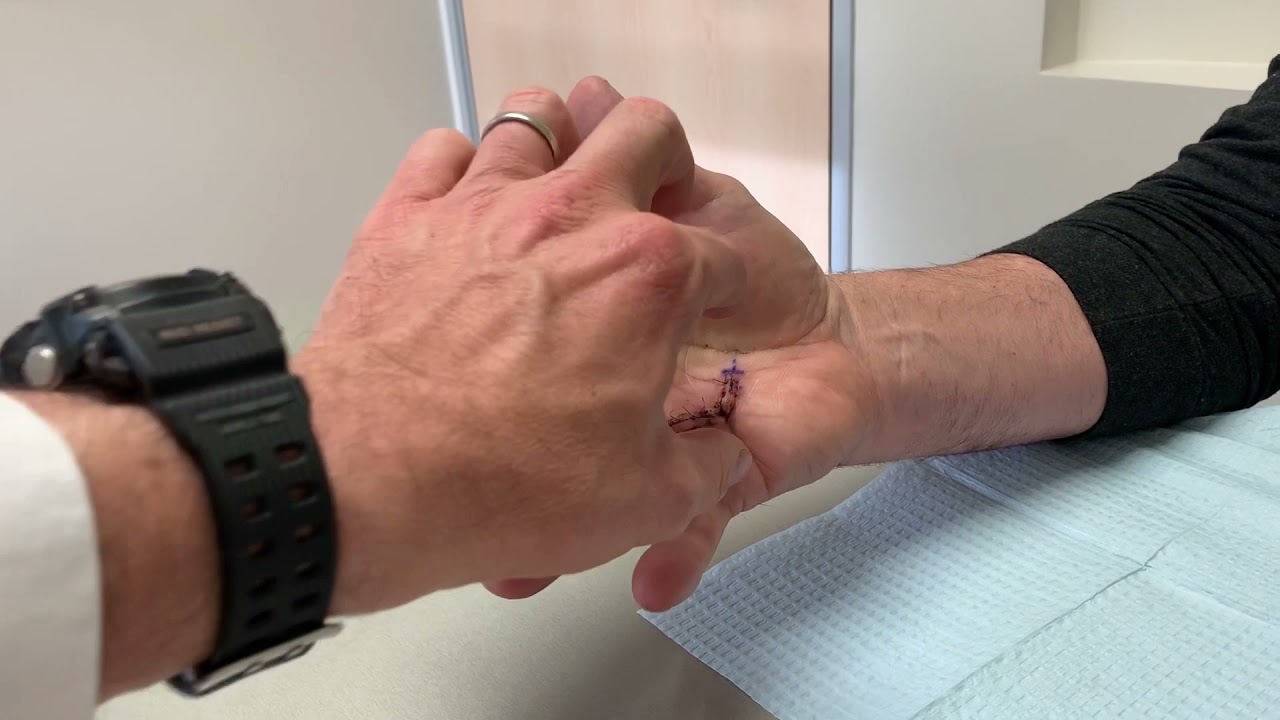 Dupuytren’s Contracture Release - YouTube