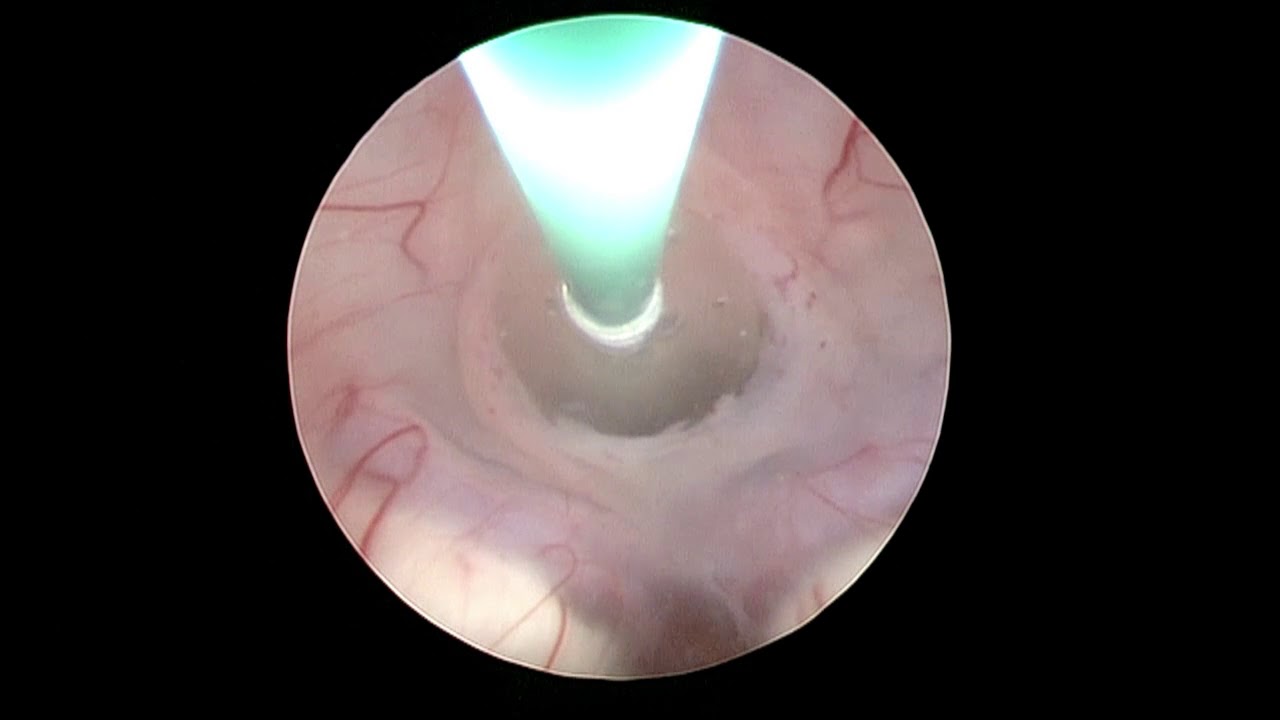 Third Ventriculostomy with the Little LOTTA® Ventriculoscope - YouTube