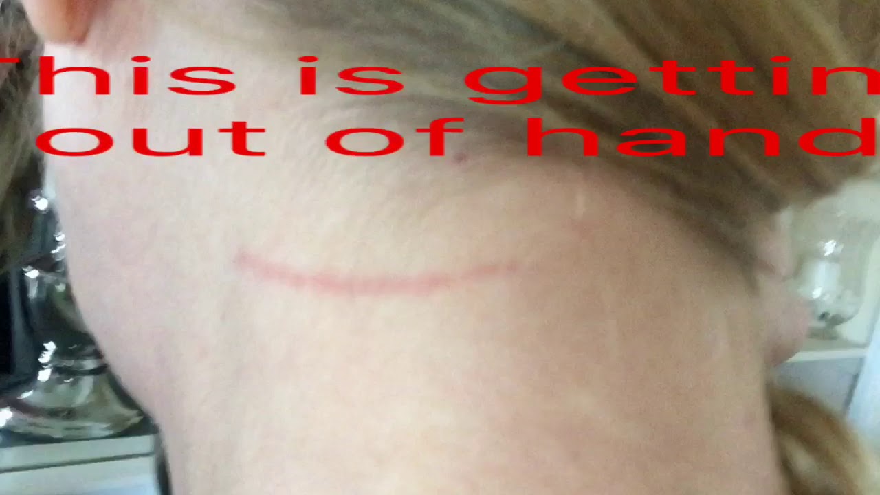 What scratched me, - YouTube