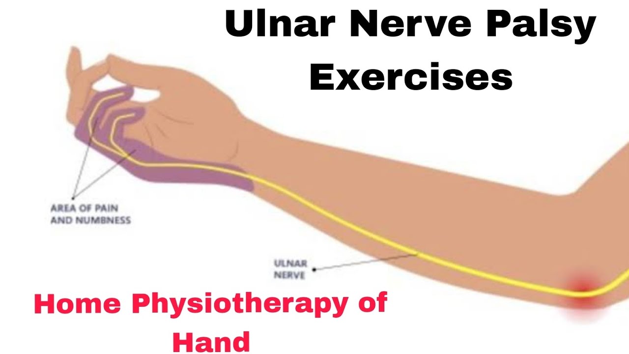 Hand Physiotherapy |Ulnar nerve entrapment Physiotherapy |Ulnar nerve ...