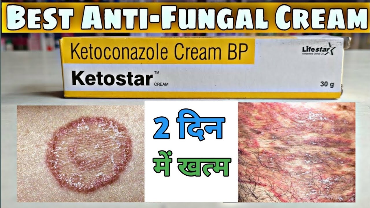 ketostar cream uses | price | composition | dose | side effects ...