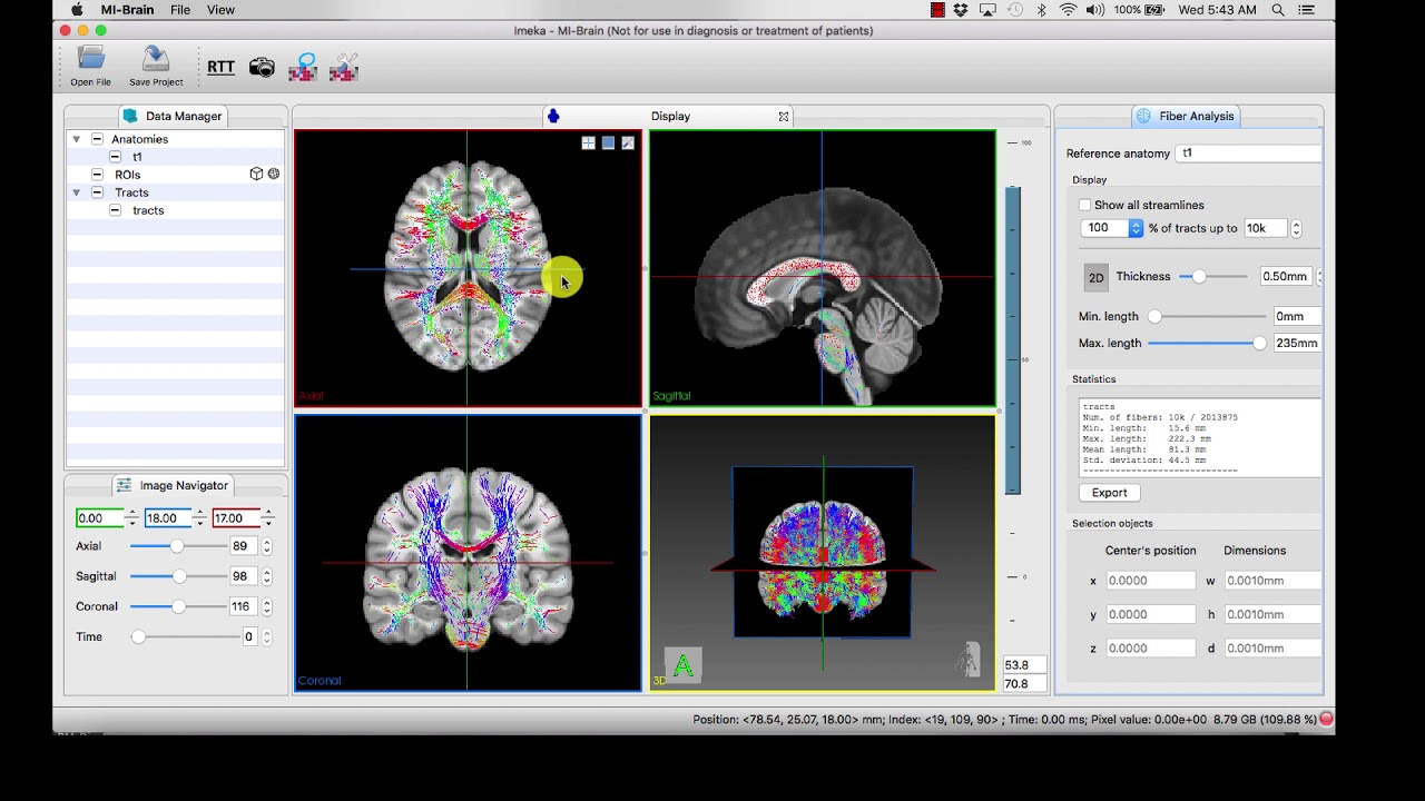 MI-Brain - 2D intersected fibers - YouTube