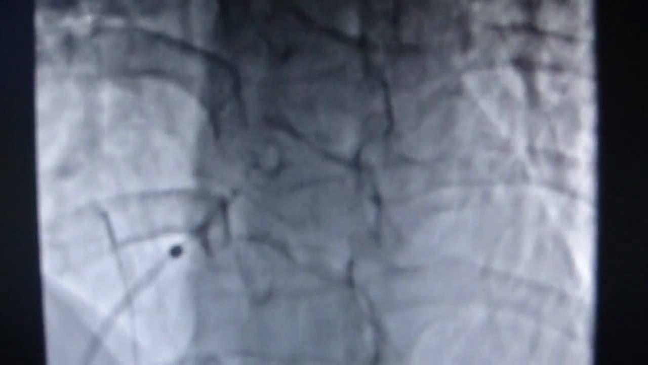 pfo closure with gore helex - YouTube