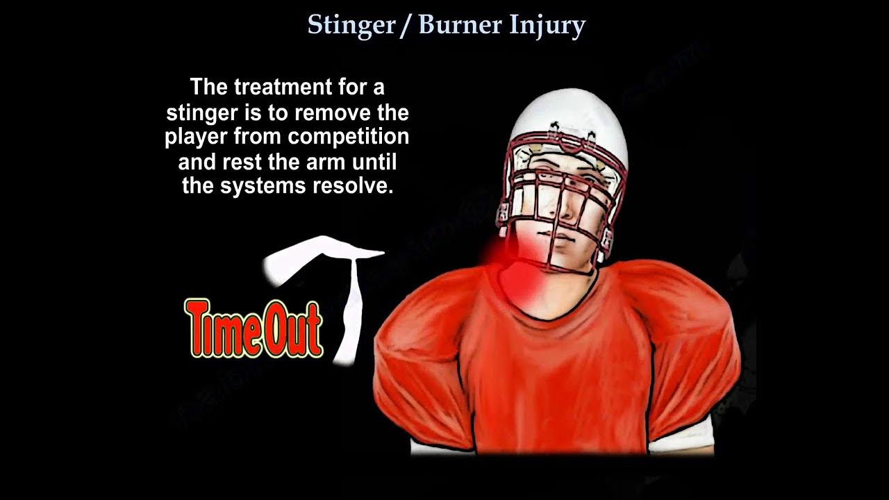 Stinger/Burner Injury: Causes, Symptoms, Treatment & When Athletes Can ...