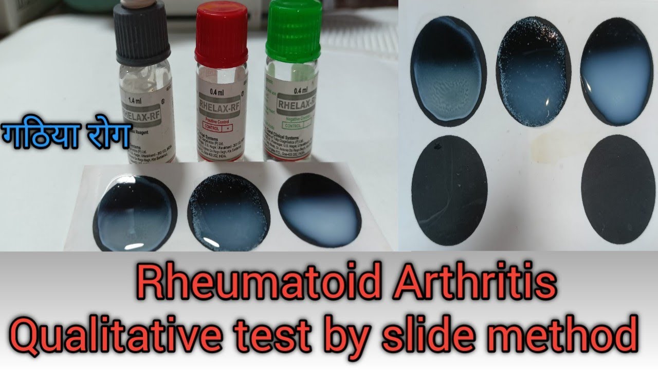 Serology test || Rheumatoid Arthritis - YouTube