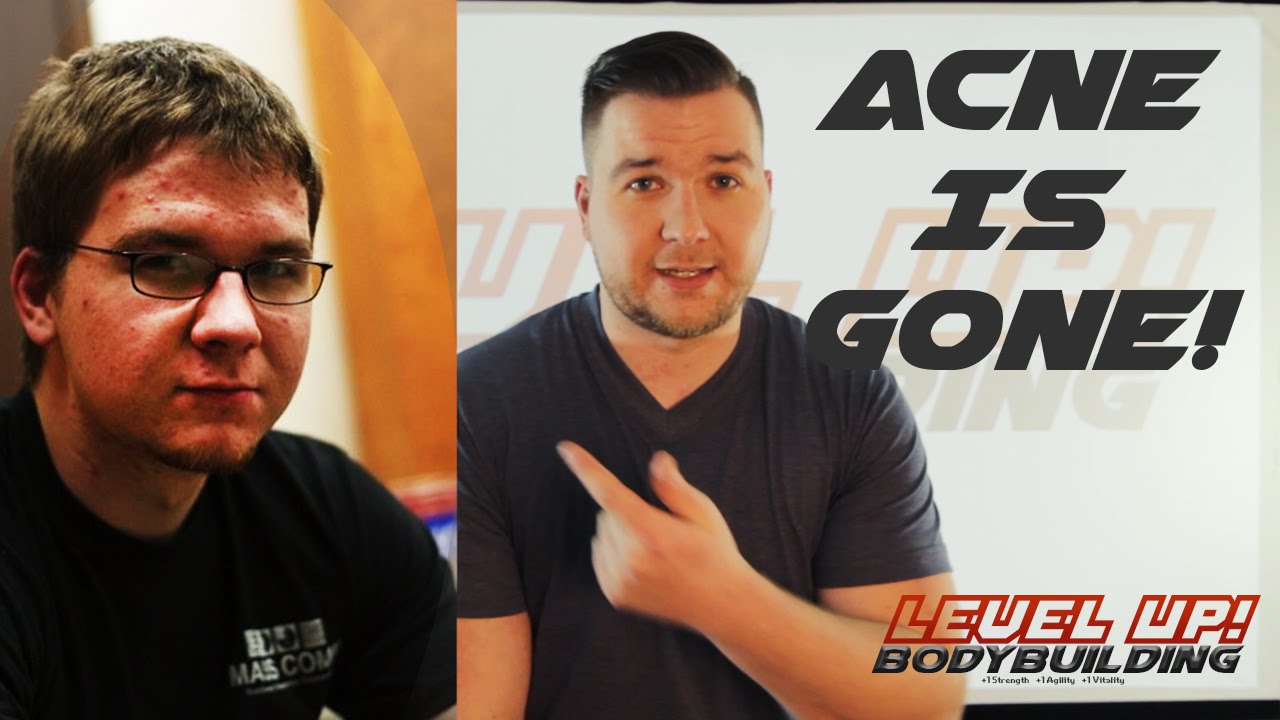 Tons of Acne... Now Gone! - LEVEL UP BODYBUILDING - YouTube