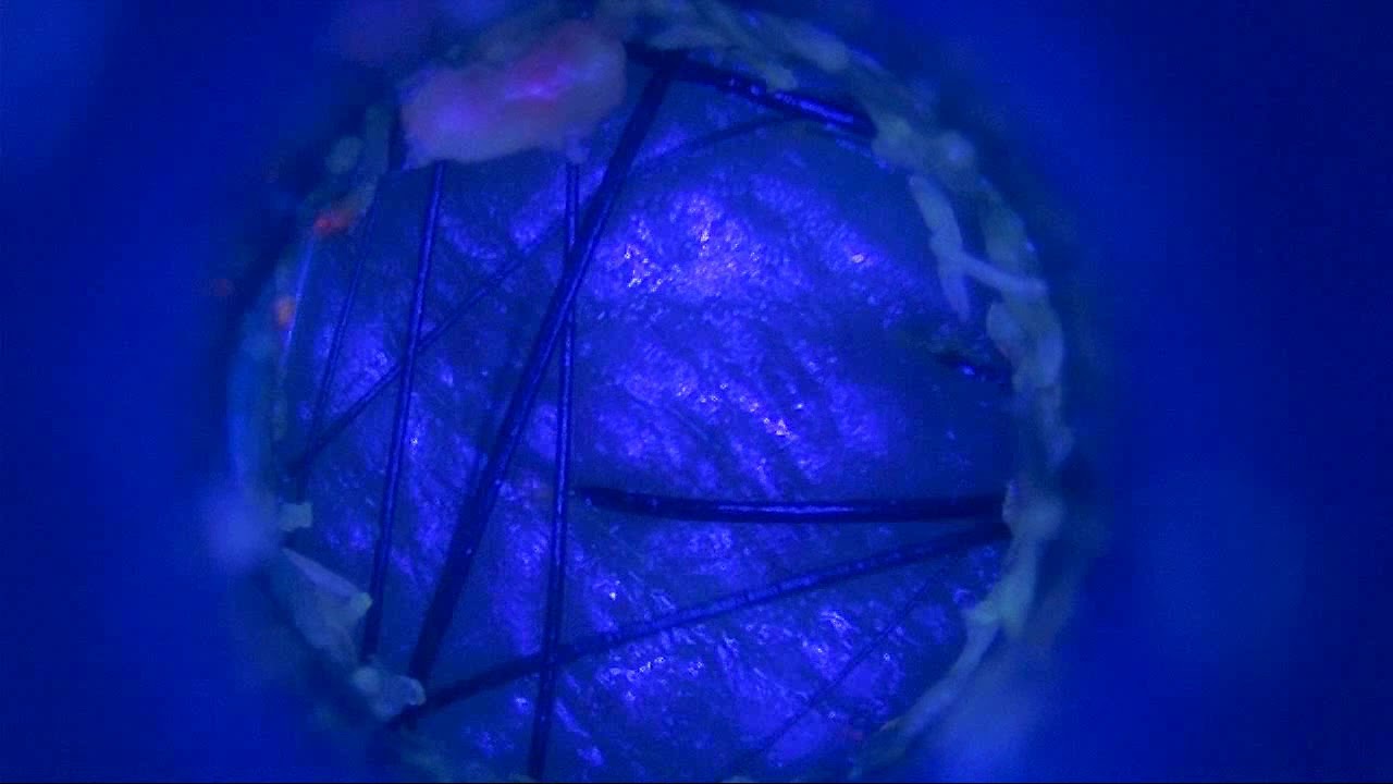 Hair Sebum extraction - Captured by SMART G-SCOPE - YouTube