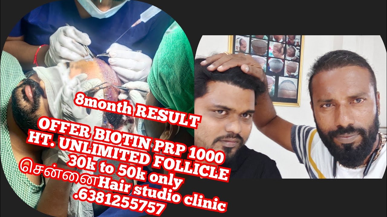 Hair Loss Treatment Biotin ( PRP ) WORTH It OR NOT ? ..Biotin prp offer ...
