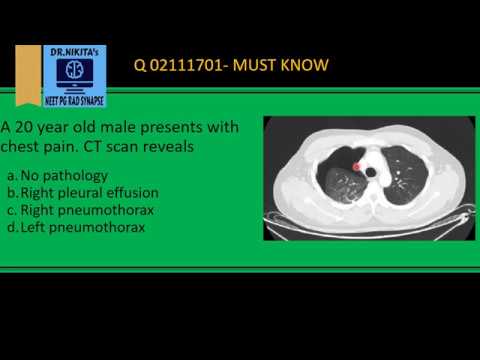 IDENTIFYING PNEUMOTHORAX ON CT - YouTube