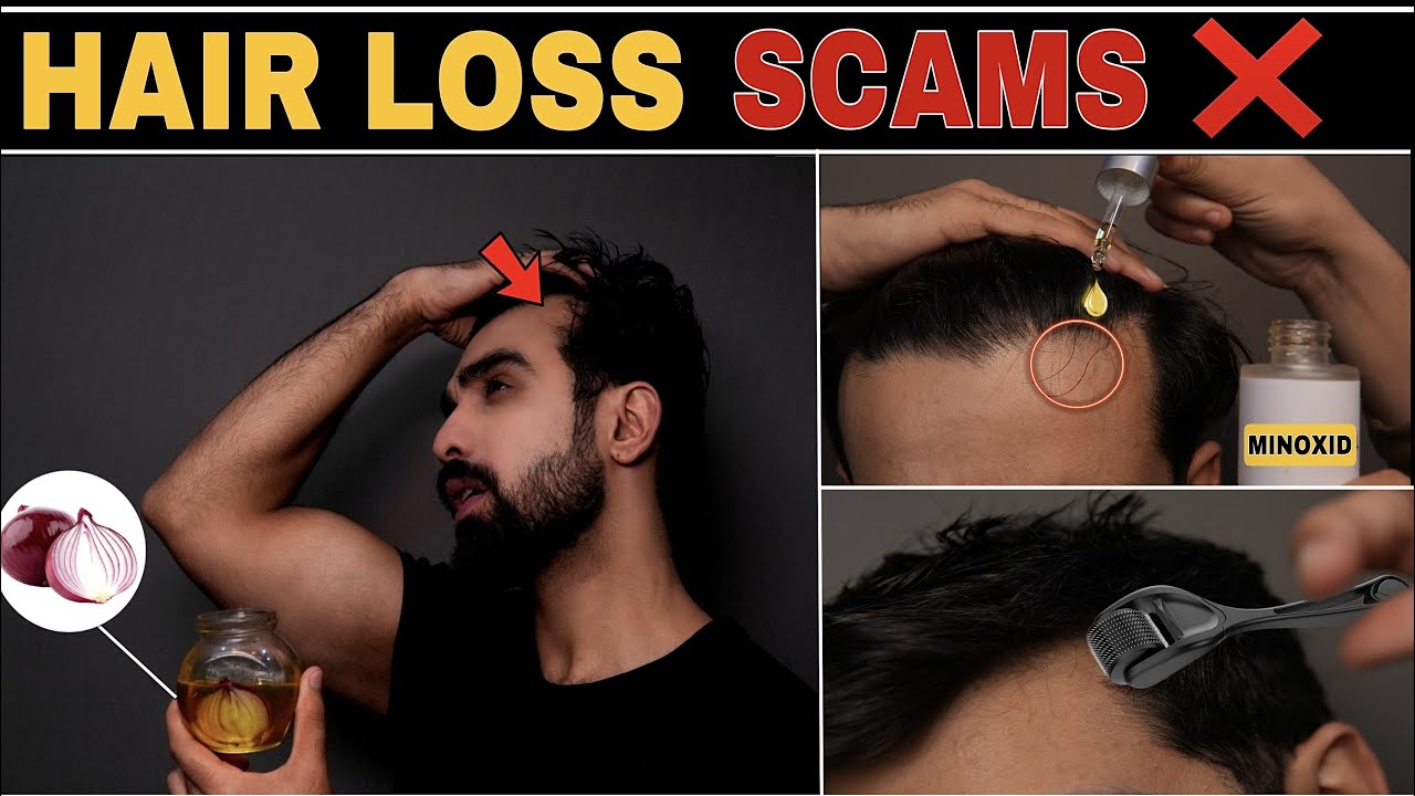 Worst Hair Loss SCAMS *NATURALLY Regrow* Teenage Hair Loss | Hair fall ...