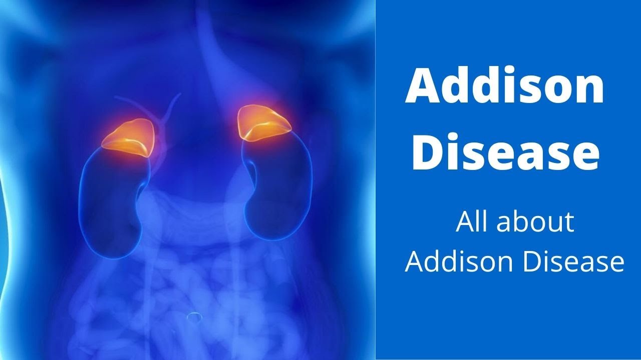 Addison's Disease - Complete Guide on Addison Disease - YouTube