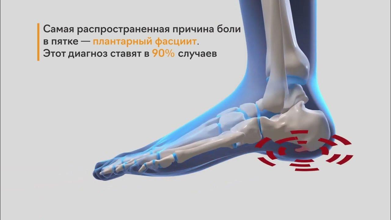 Ортопедические стельки от боли в пятке и пяточной шпоры - YouTube