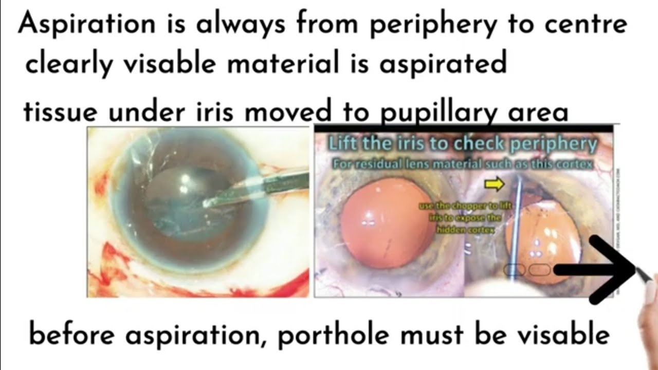 Sics -Tips for safe Cortical aspiration - YouTube