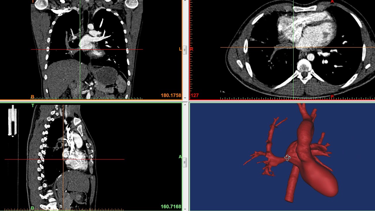 Case #31 : Pulmonary Vein stenosis after Scimitar Syndrome Repair - YouTube