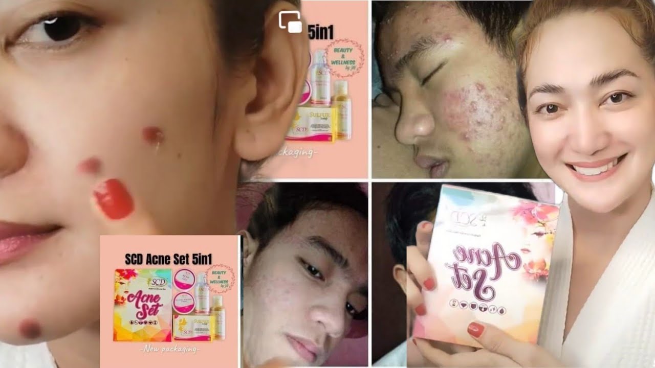 The SCD ACNE SET ang SET na para sa mga tigyawat na ayaw kayong ...