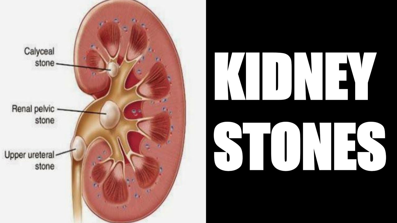 KIDNEY STONES RENAL CALCULI YouTube KIDNEY STONES RENAL CALCULI YouTube