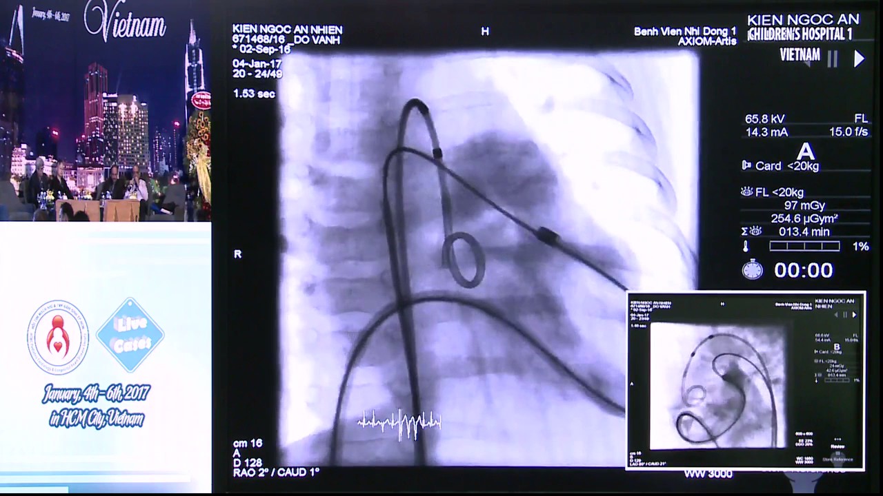 Lifetech KONAR-MF fistula live case by Prof. Kevin Walsh and Dr. Tin in ...