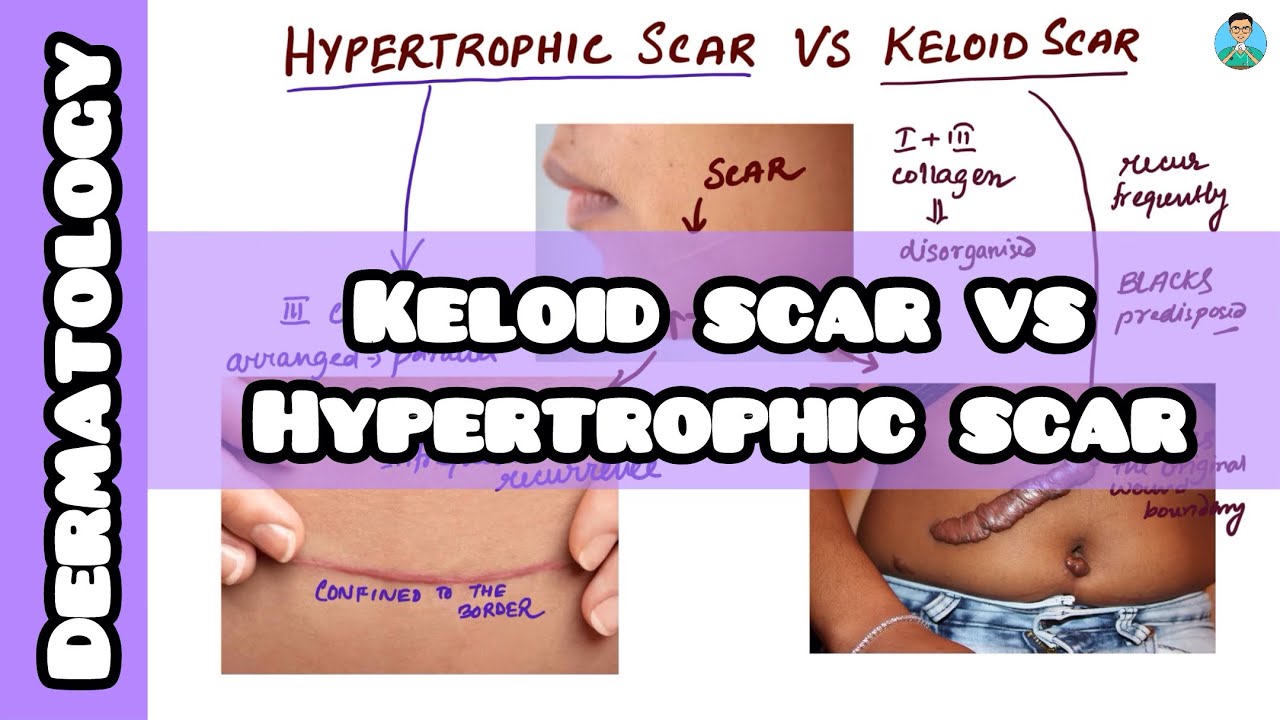 Keloid vs Hypertrophic Scar: #dermatology #usmle #firstaid for #inicet ...