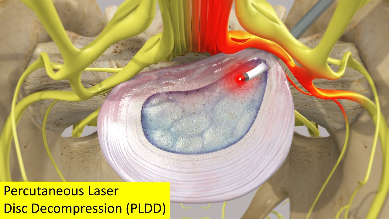 Percutaneous laser disc decompression (PLDD) - YouTube