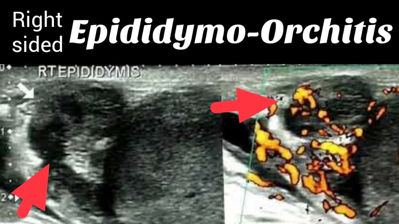 Right sided Epididymo-Orchitis | Testicular Inflammation - YouTube