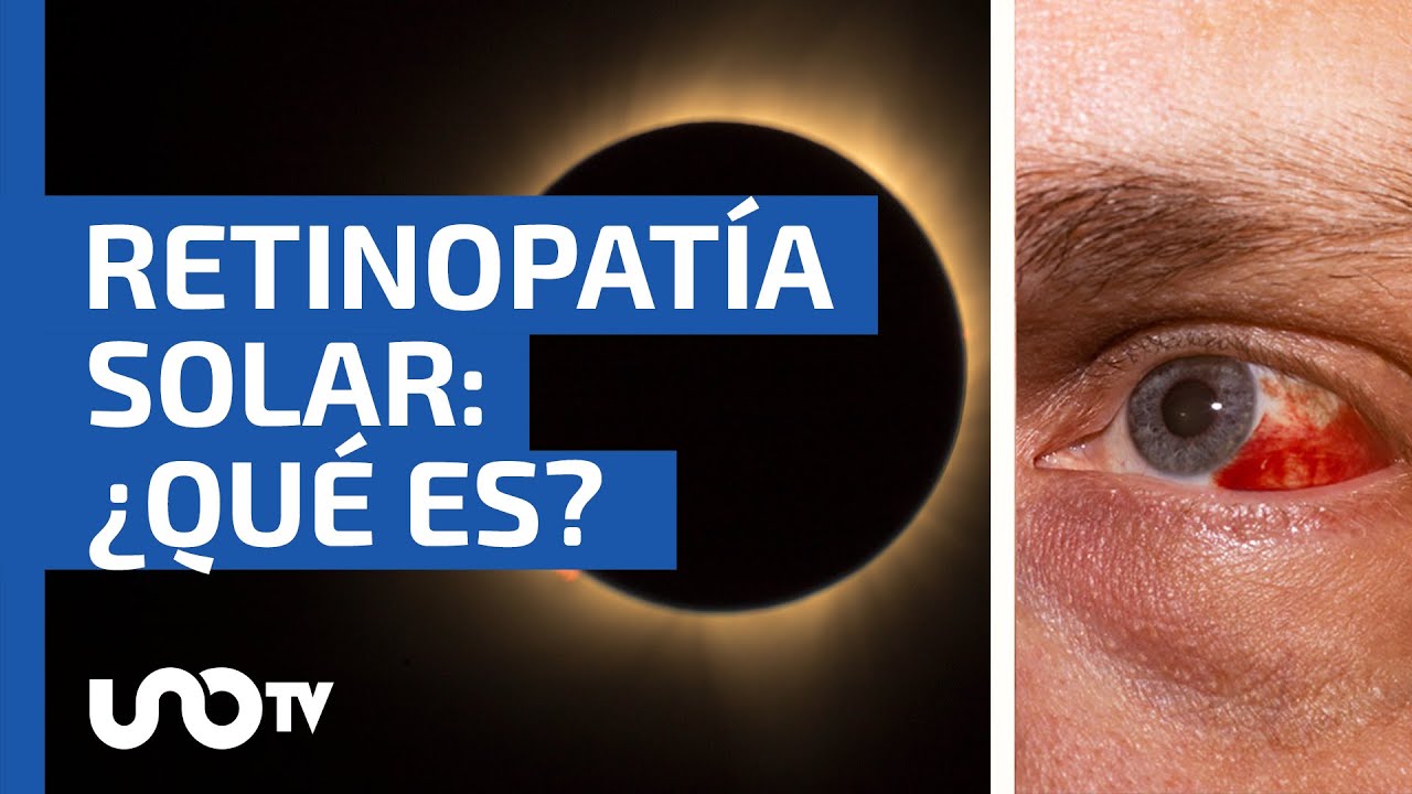 Retinopatía solar: ¿qué es esta afección que puede causar ceguera por ...
