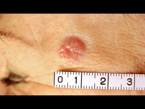 Basalioma, cos'è e come prevenire il tumore che ha colpito Valentina ...