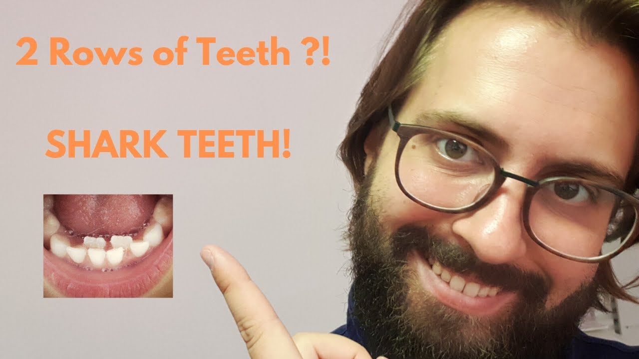 My kid’s tooth is growing behind his baby teeth ?! Shark teeth! - YouTube