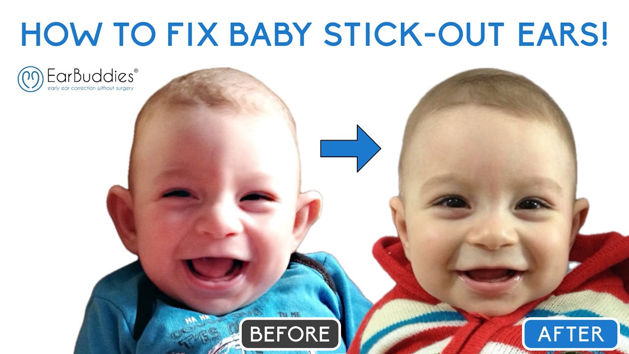 EarBuddies - Fix your Baby's Stick-Out Ears at Home! - YouTube
