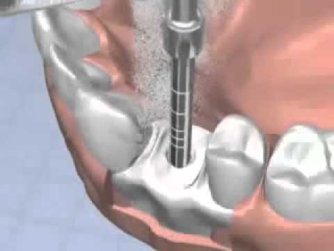 Dental Implant Animation - YouTube