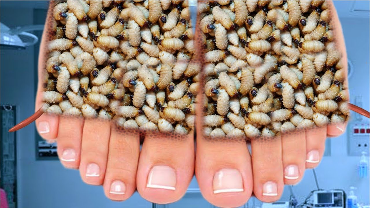 ASMR Treatment 2D Animation | Infected foot treatment | darti ...